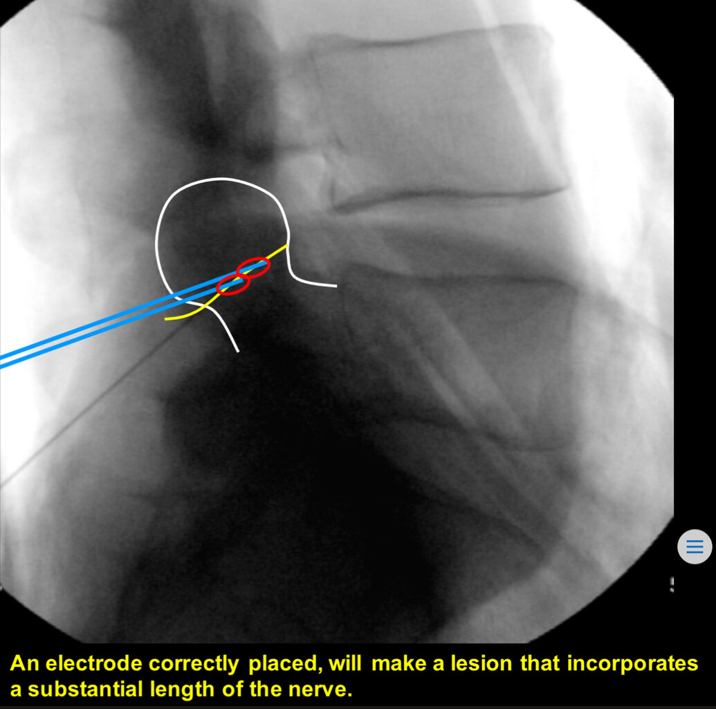 Lumbar RFA Technique | Page 3 | Student Doctor Network Forums